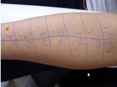 Allergietest - Dr. med. Christoph Baumbach